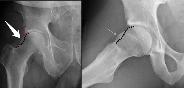 Femoroacetabular Impingement: what is it and how is it treated ...